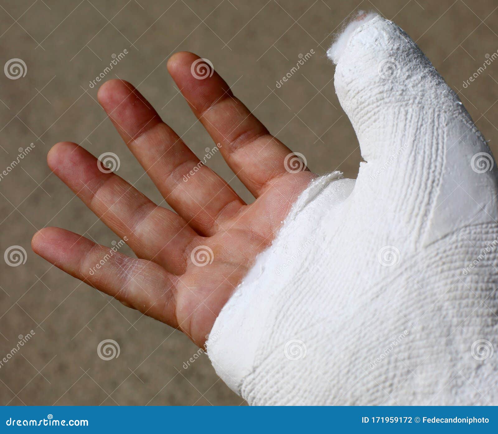 Hand Fracture Plaster