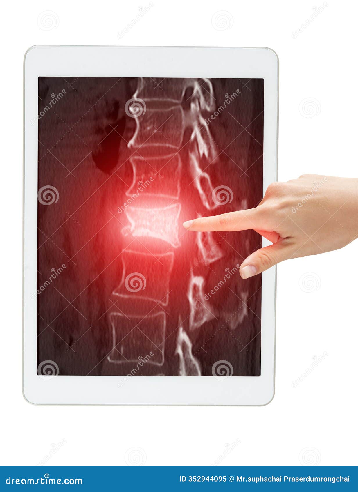 .a Hand Points at a Tablet Screen Showing a CT Scan of the Lumbar Spine ...