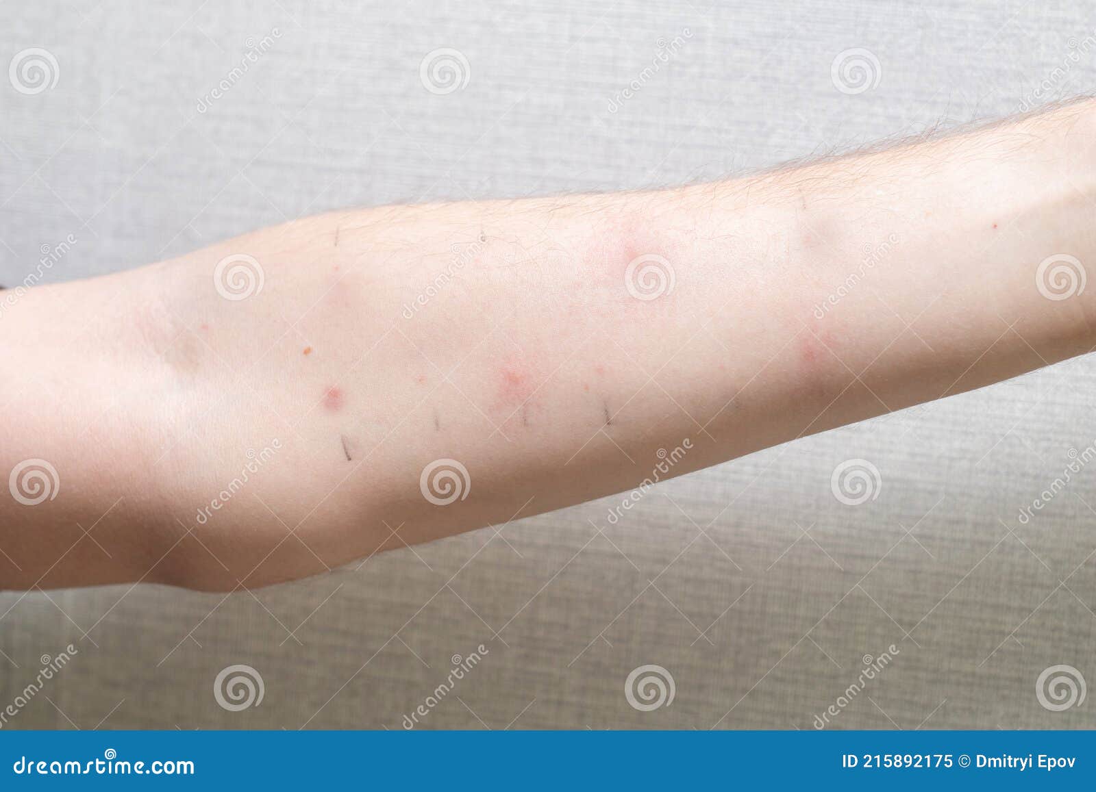 Hand with Positive Allergy Tests. Allergy Tests on the Arm Stock Image ...