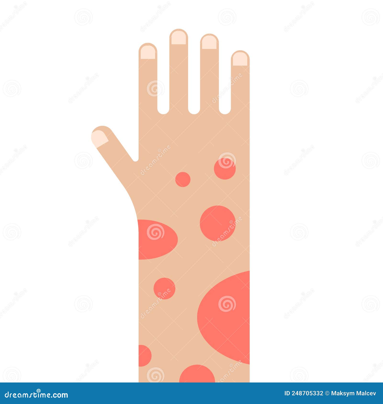Hand with Psoriasis Wounds. People Suffering from Psoriasis Banner ...