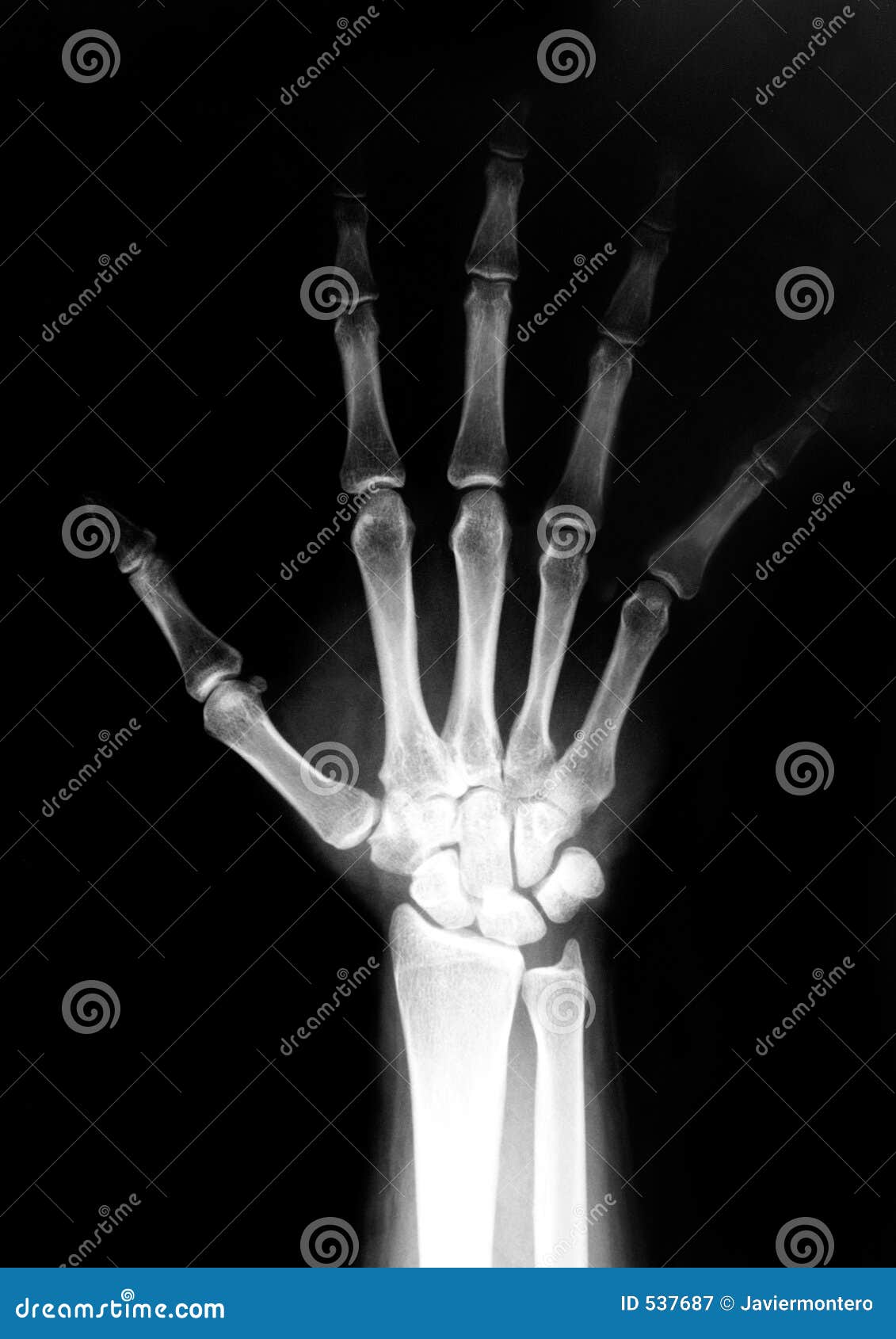 Hand radiograph stock image. Image of bodily, radiation - 537687