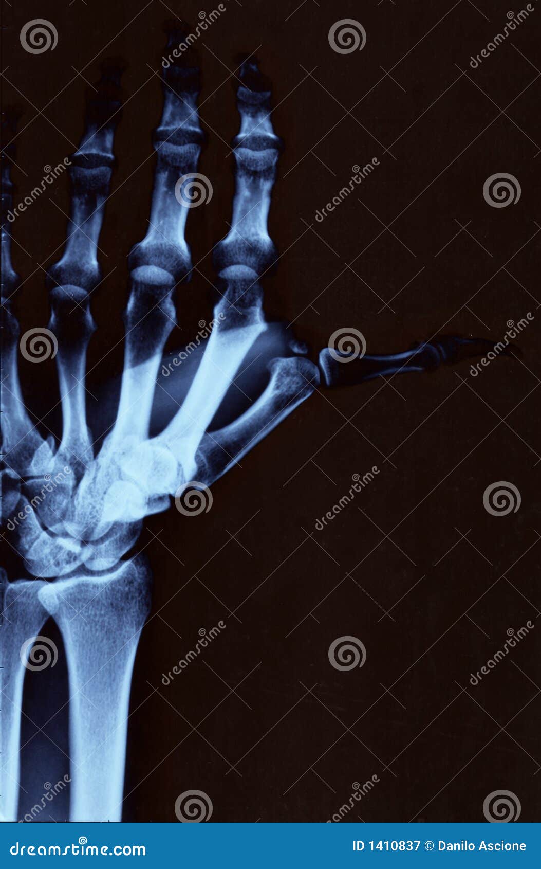 Hand radiography stock image. Image of aided, palm, exam - 1410837