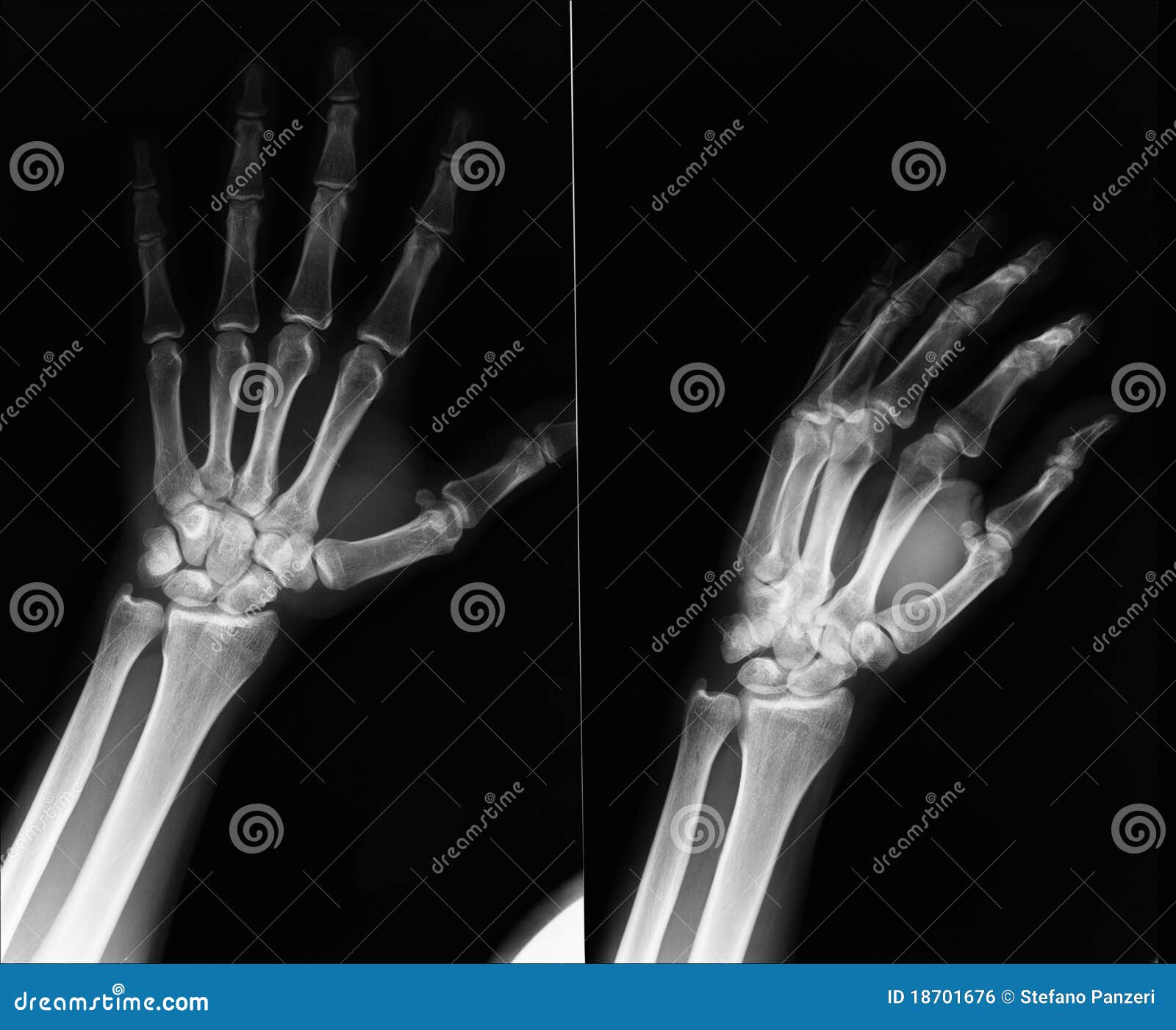 Hand X-Ray stock photo. Image of report, anatomy, examine - 18701676