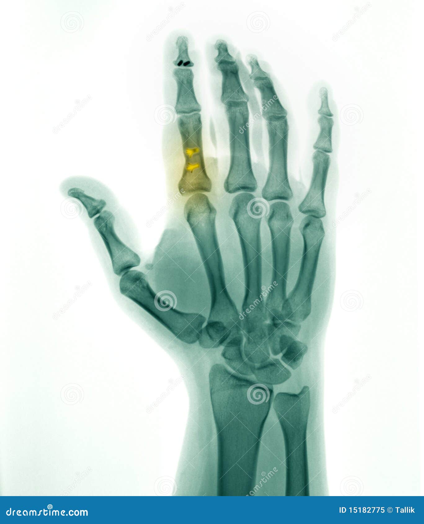 Hand X-ray, Flexor Tendon Repair Stock Image - Image of repair, flexor ...