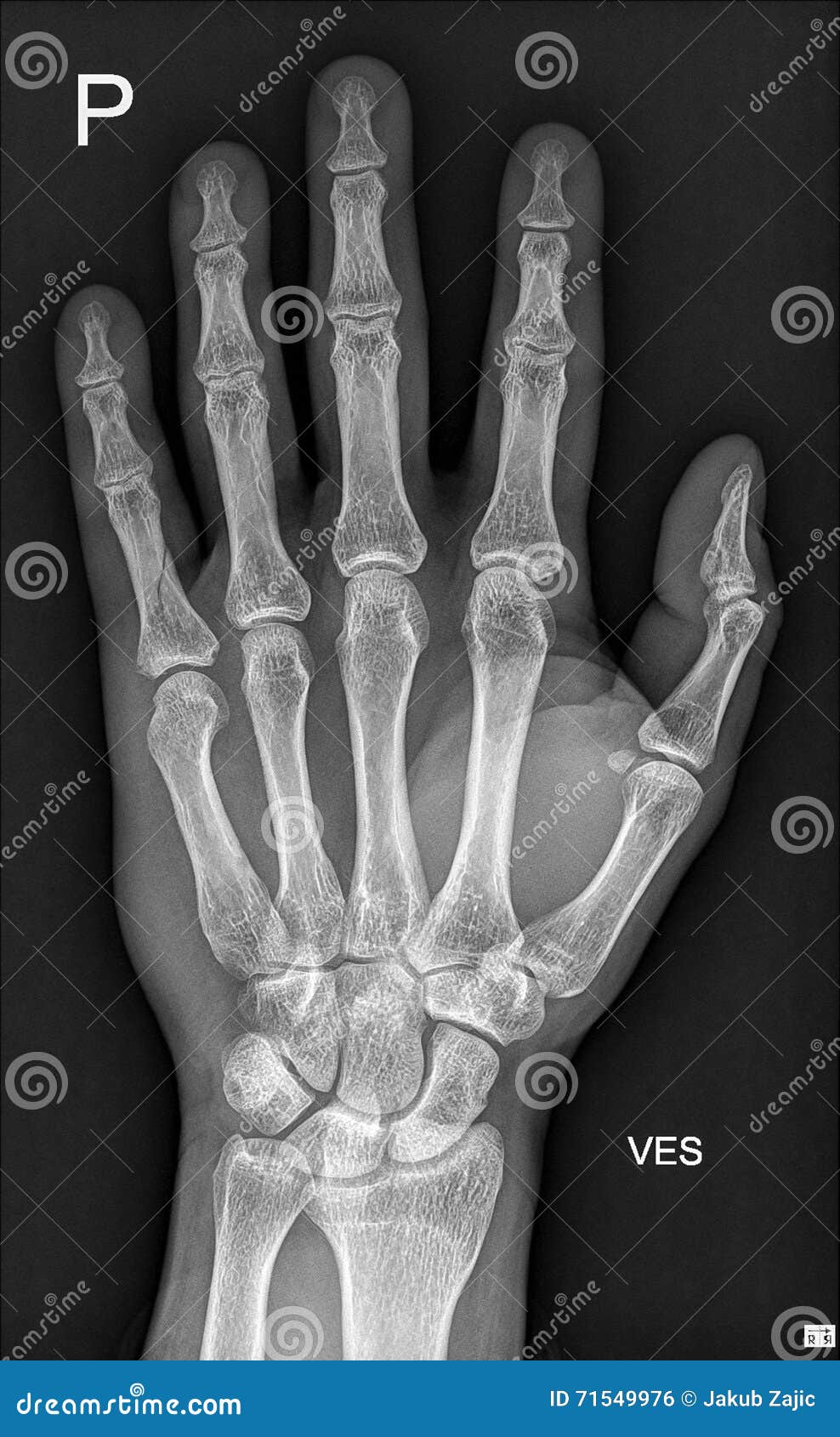 Hand X-Ray stock photo. Image of illness, health, background - 71549976