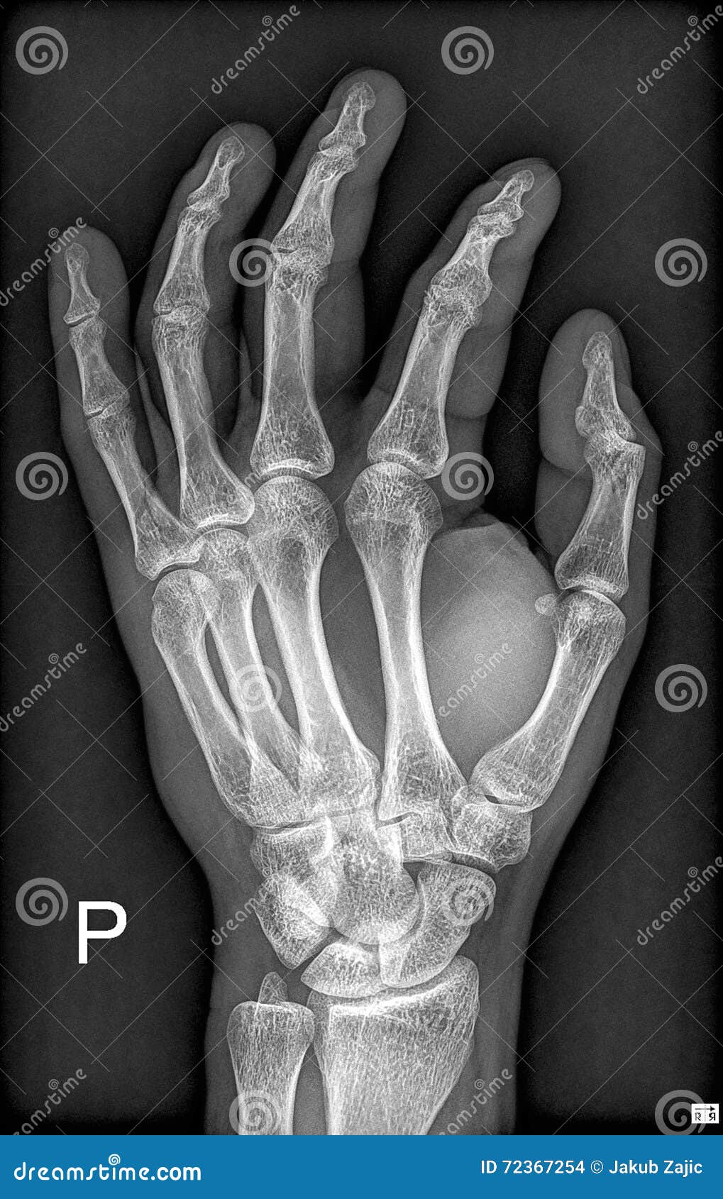 Hand X-Ray stock photo. Image of index, cure, healthcare - 72367254
