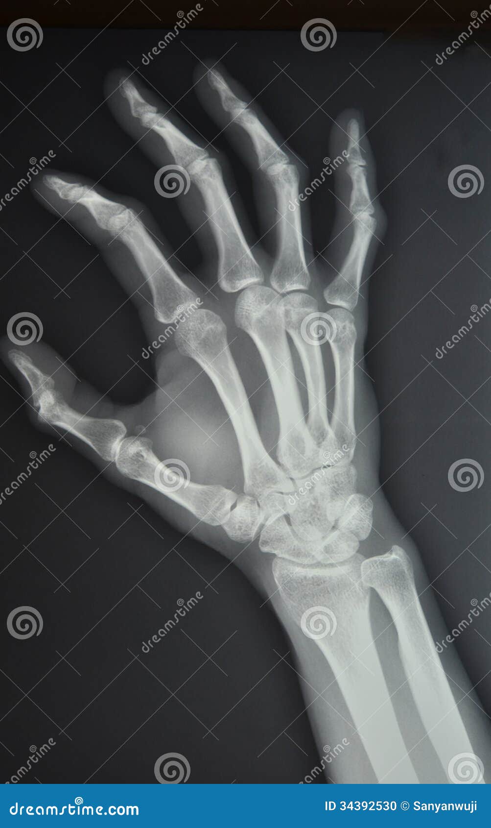 Hand X-ray stock photo. Image of palm, anatomy, human - 34392530