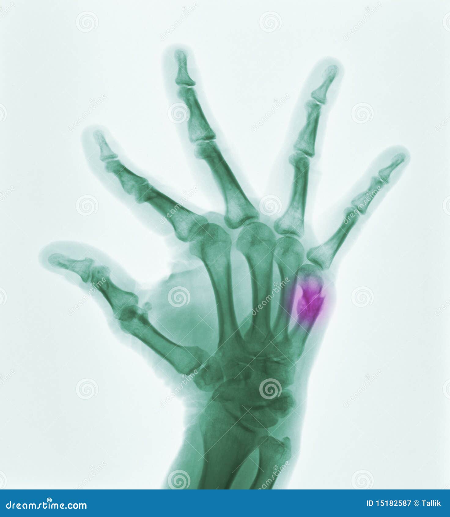 Hand X-ray Showing a Boxer S Fracture Stock Image - Image of pain, xray ...