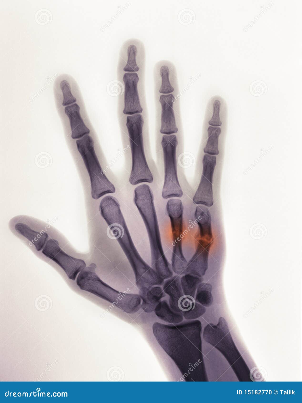 Hand X-ray Showing a Boxer S Fracture Stock Photo - Image of xray ...