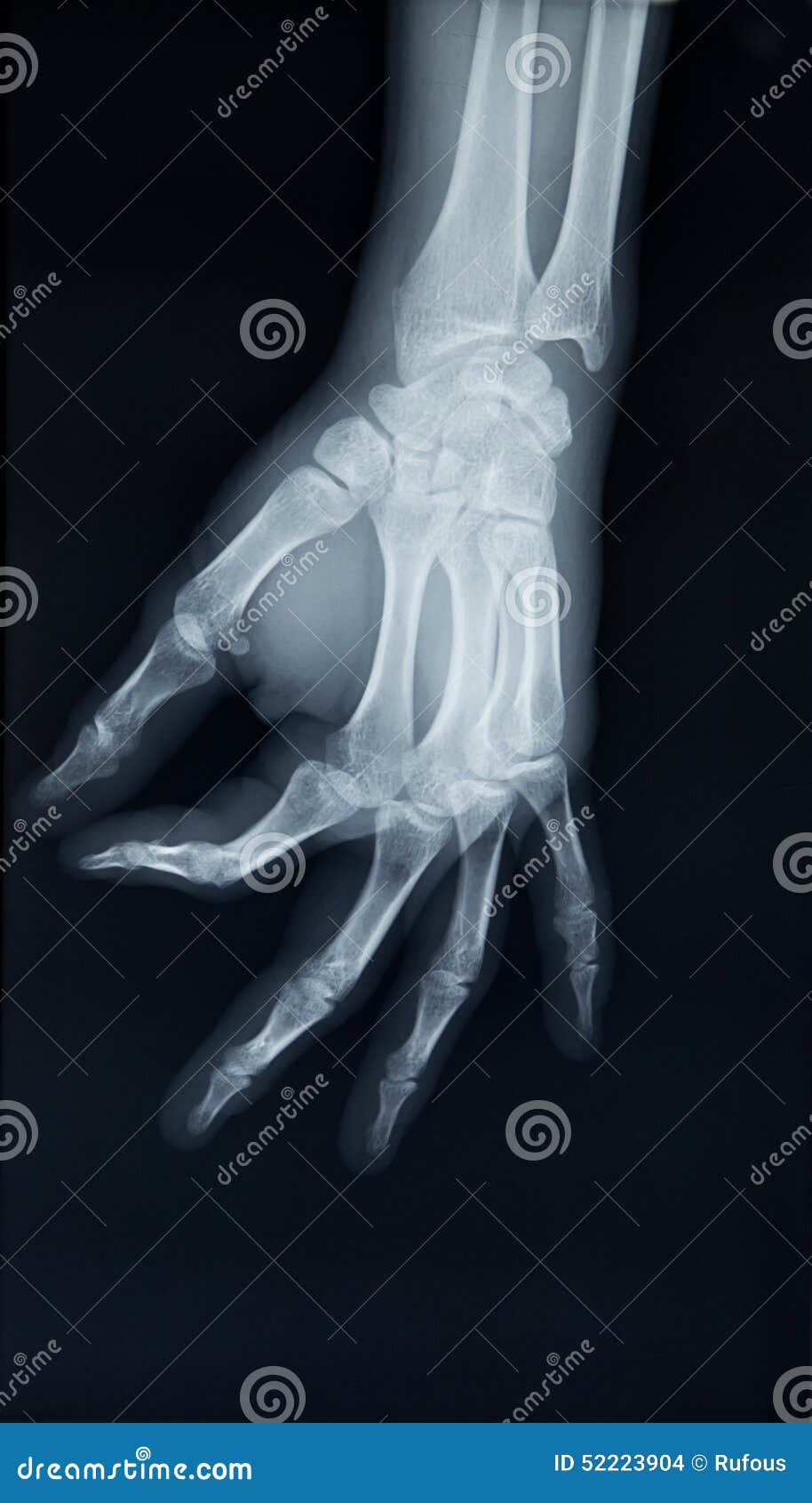 Hand X-ray View on a Black Background Stock Photo - Image of healthcare ...