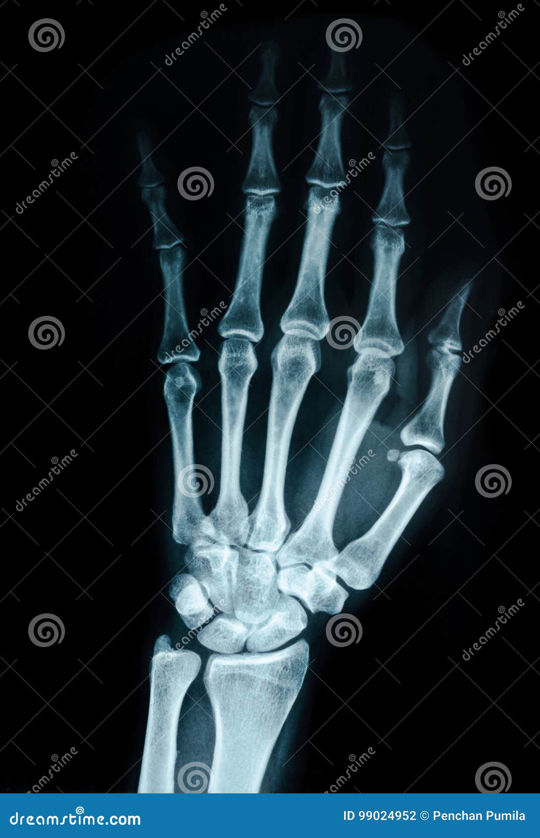 Hand x-ray view. stock photo. Image of medical, hand - 99024952