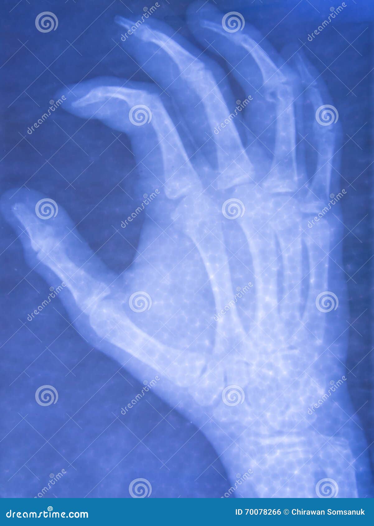 Hand x-ray view stock photo. Image of bone, roentgenogram - 70078266