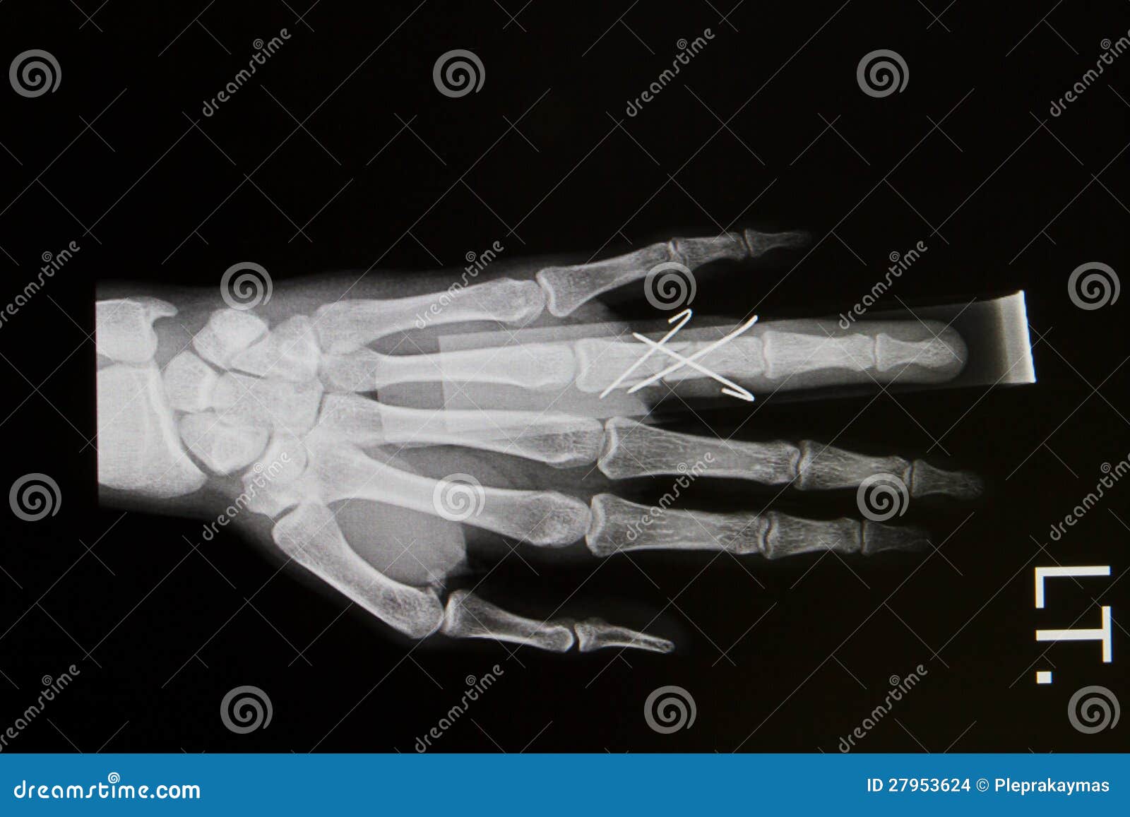 Hand x-rays image stock photo. Image of elbow, bone, fracture - 27953624