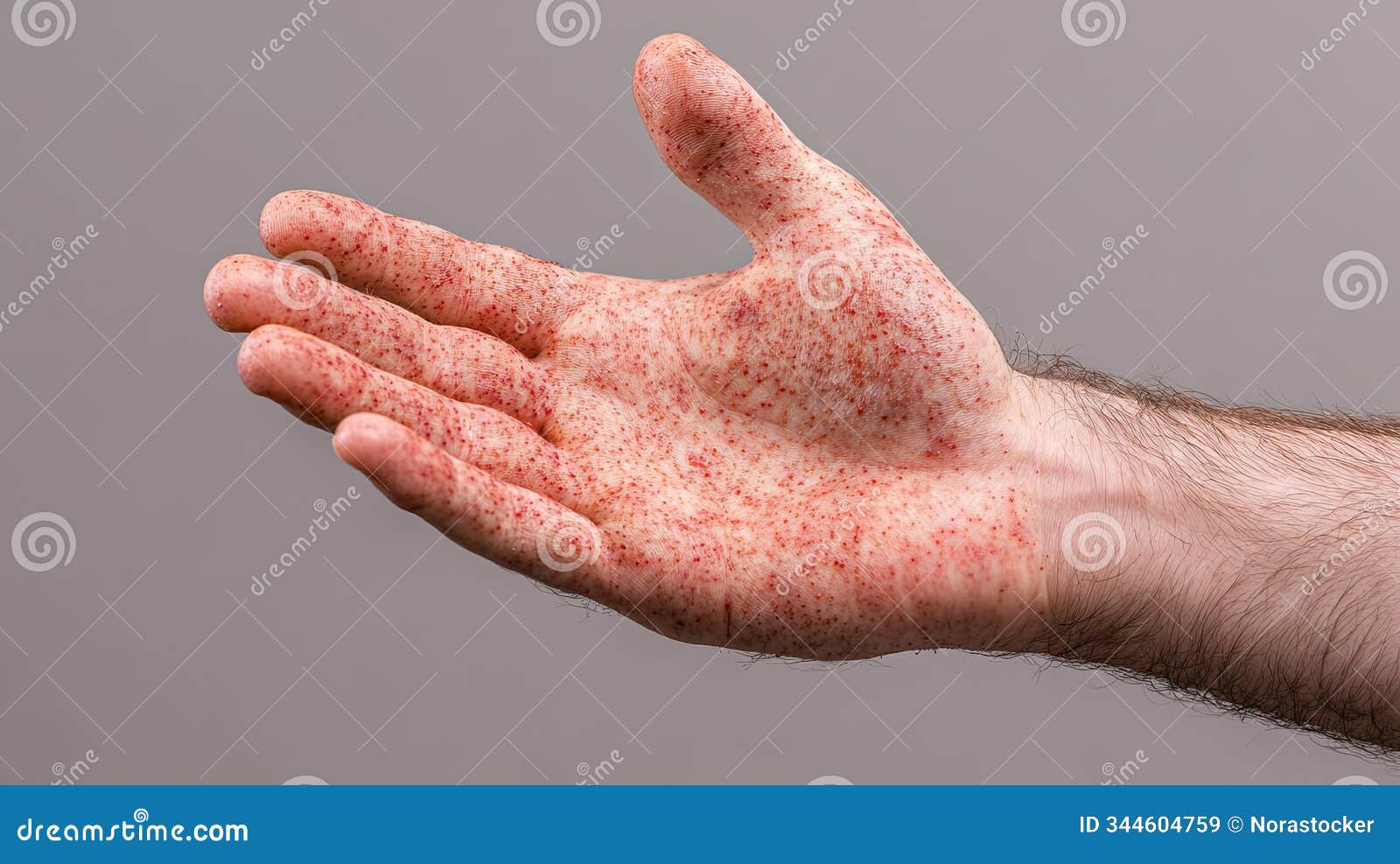 A Hand with Red Spots on it is Being Held Up. Quality Stock Image ...