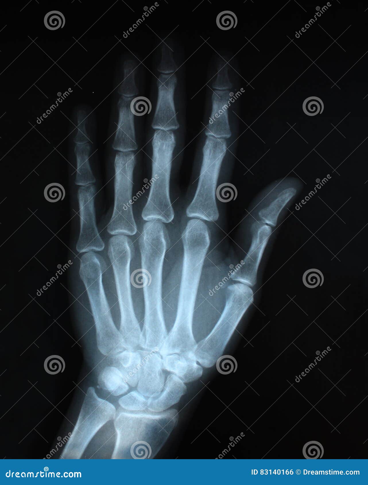 Hand rontgen stock photo. Image of imaging, medical, bone - 83140166