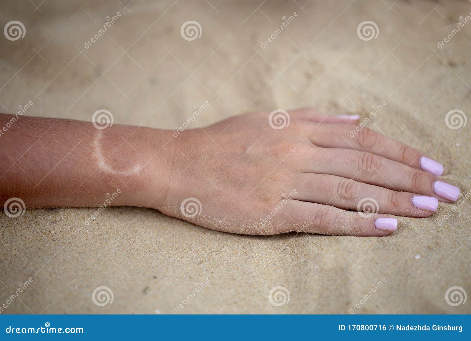 Man Arm And Hand With Keloid Scar, Hypertrophic Scar On Skin Royalty ...
