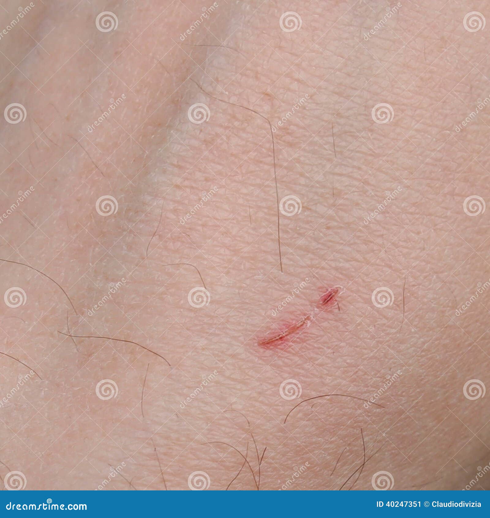Hand scar stock image. Image of wound, scar, hand, accident - 40247351