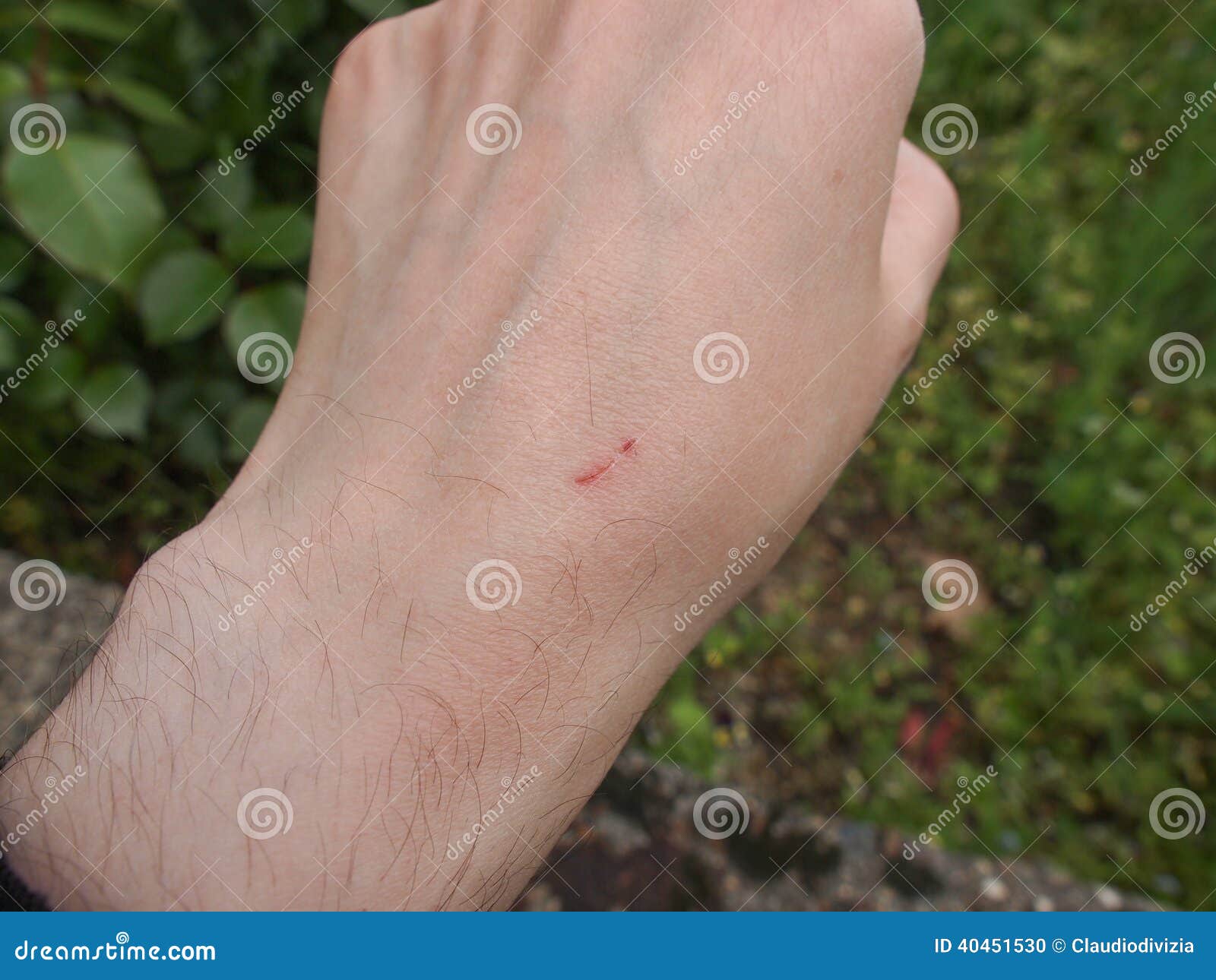Hand With Scar Due To Scaphoid Bone Fracture. White Background. Stock ...