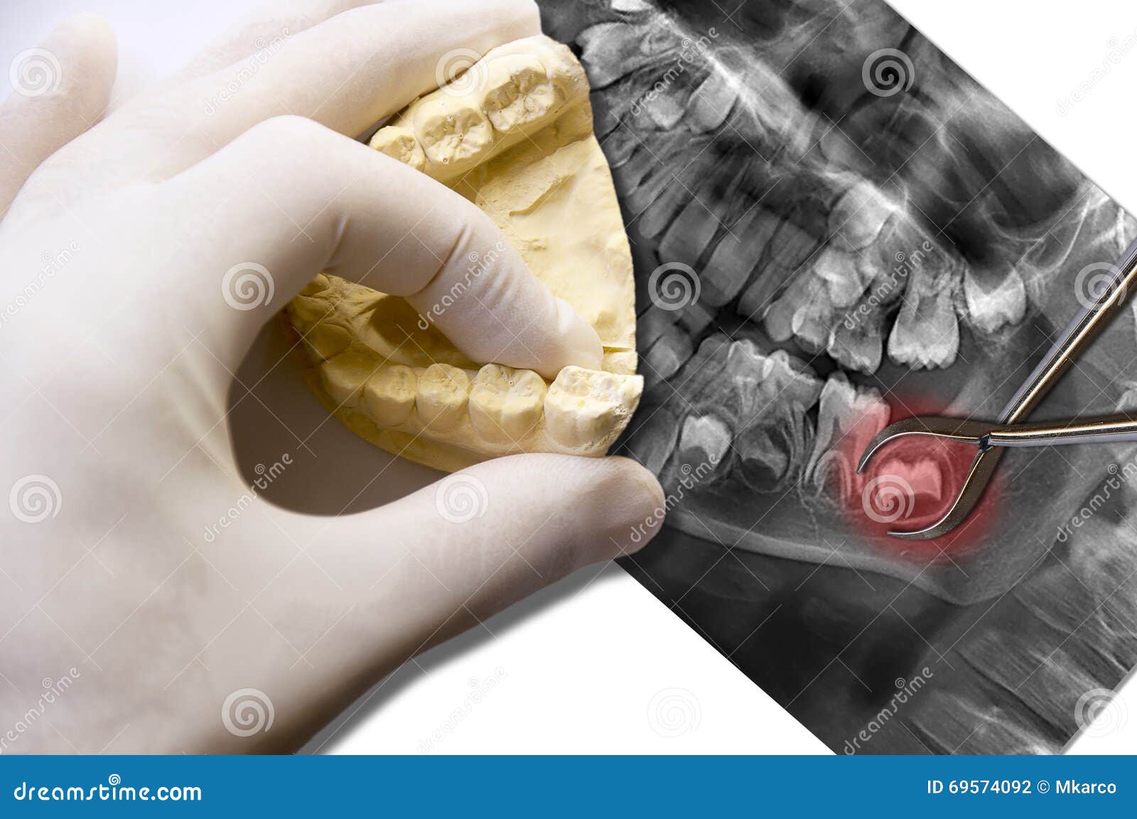 Hand Show Molar Tooth and Toothache Wisdom Tooth Stock Photo - Image of ...