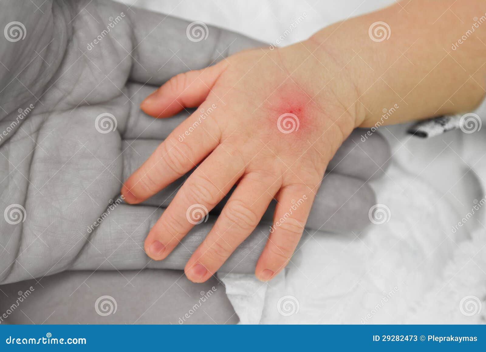 Hand of Sick Baby with Tracks Injection ( Post I .V Injection) O Stock ...