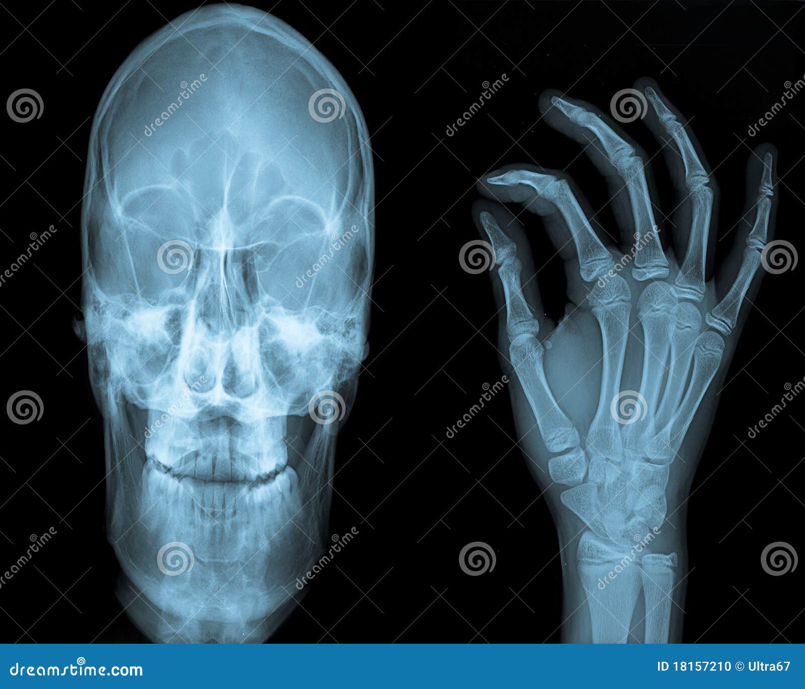 Hand & Skull X Ray stock photo. Image of surgery - 18157210