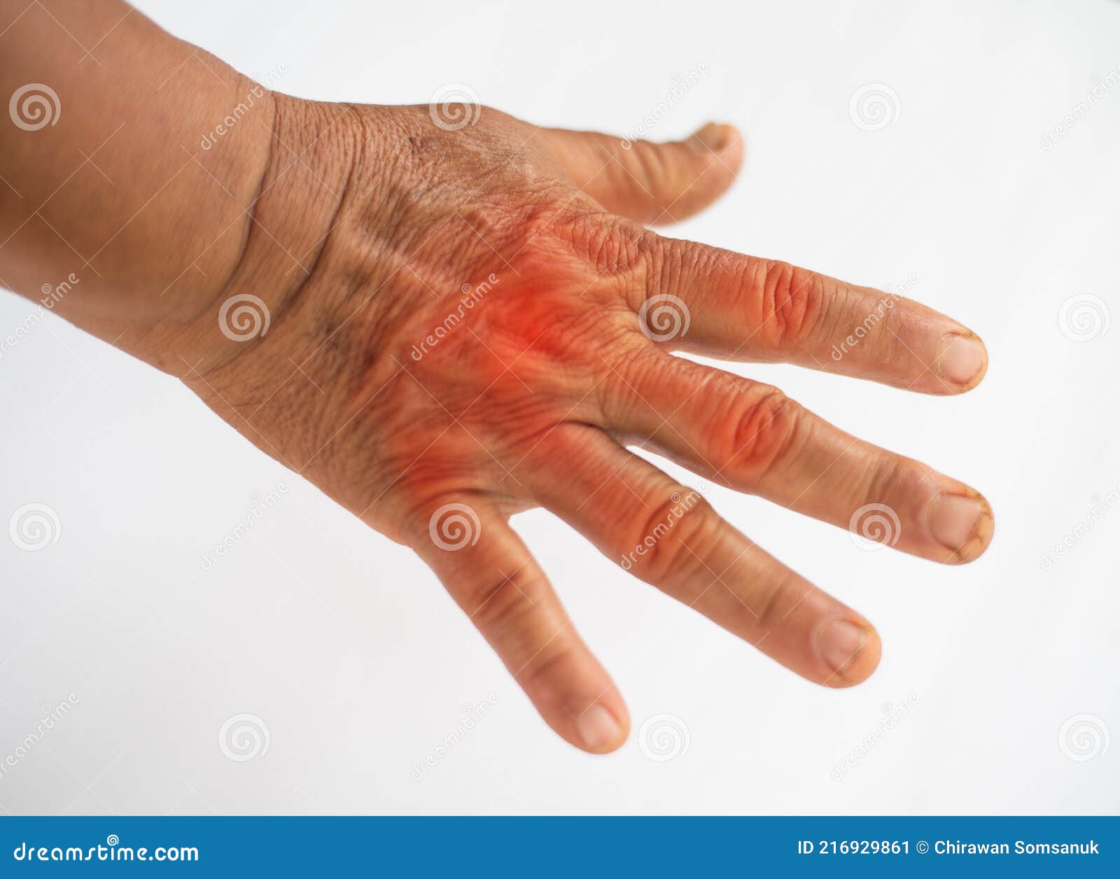 Hand Suffering from Joint Pain with Gout Stock Image - Image of colored ...