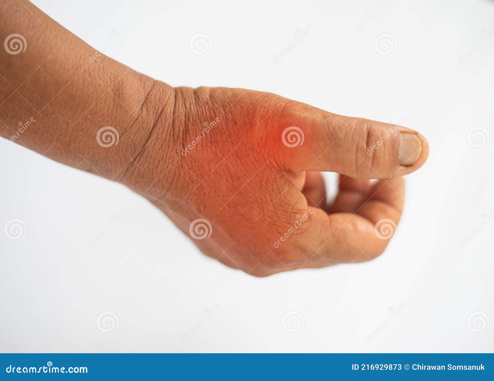 Hand Suffering from Joint Pain with Gout Stock Image - Image of ...