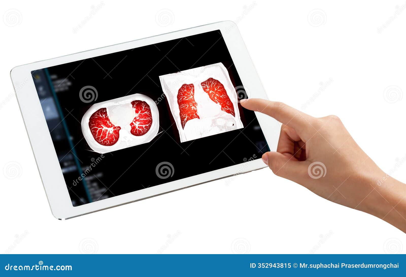 Hand Touching Tablet Display of CT Chest Scan Shown on a Tablet Screen ...