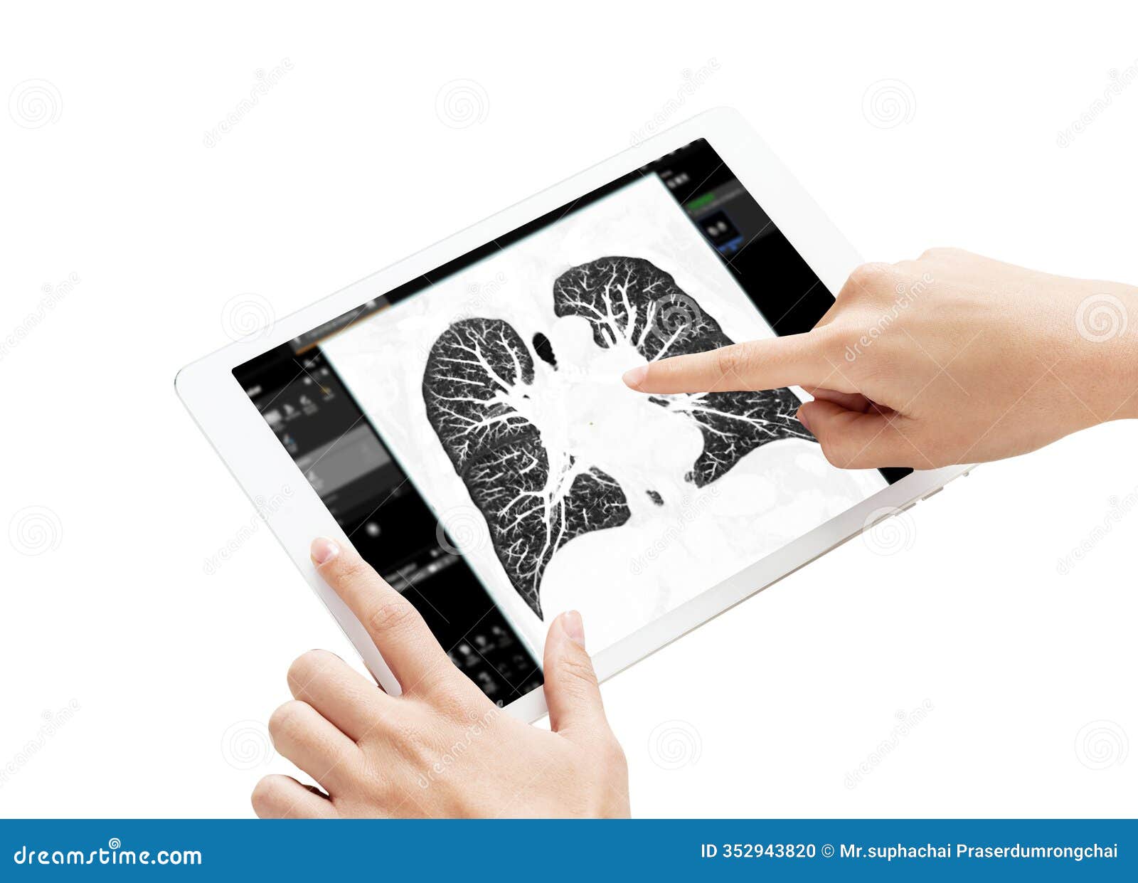 Hand Touching Tablet Display of CT Chest Scan Shown on a Tablet Screen ...