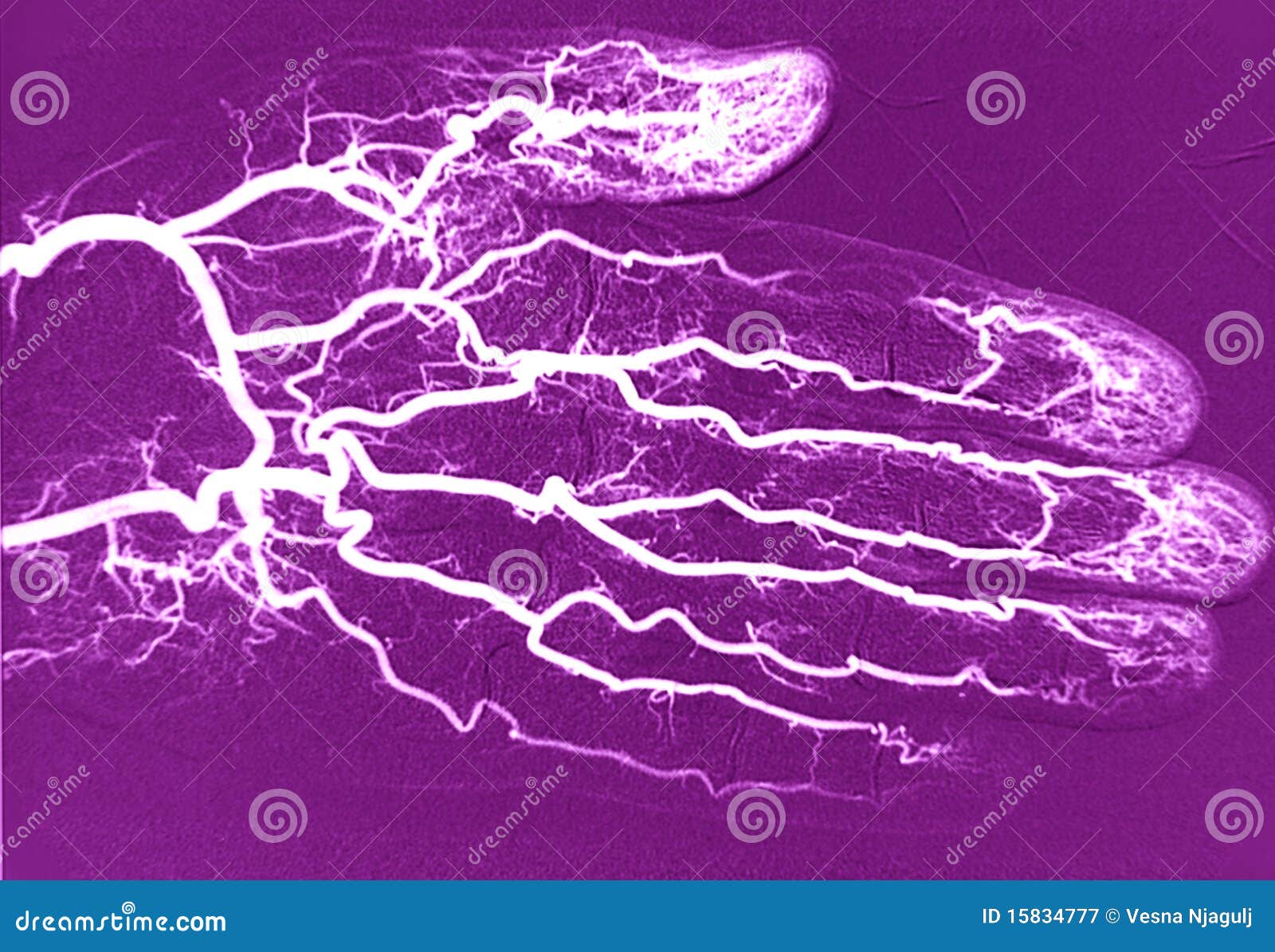 Hand Vessels, Angiography, Arteriography Stock Image - Image of artery ...