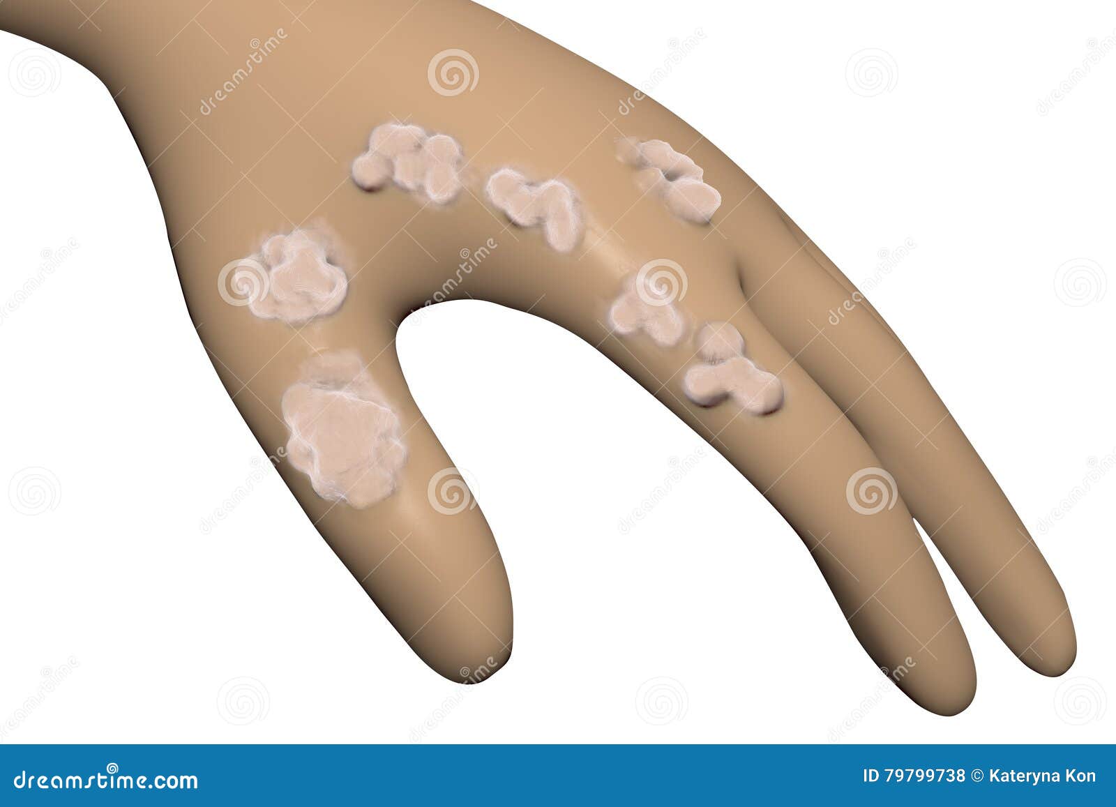 Hand with warts stock illustration. Illustration of mucous - 79799738