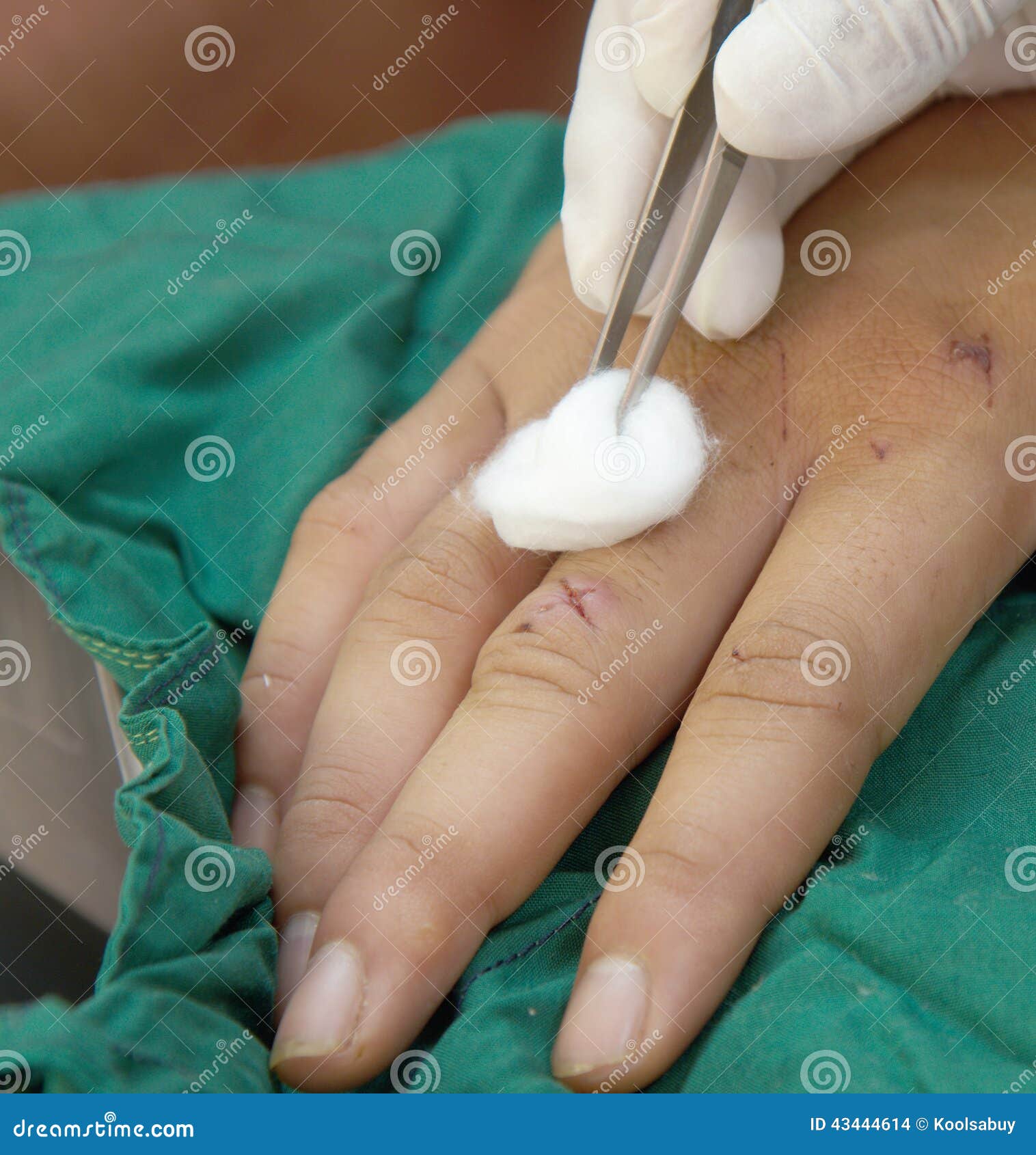 Hand Was Cut Stitch Suture. Stock Photo - Image of closeup, bandage ...