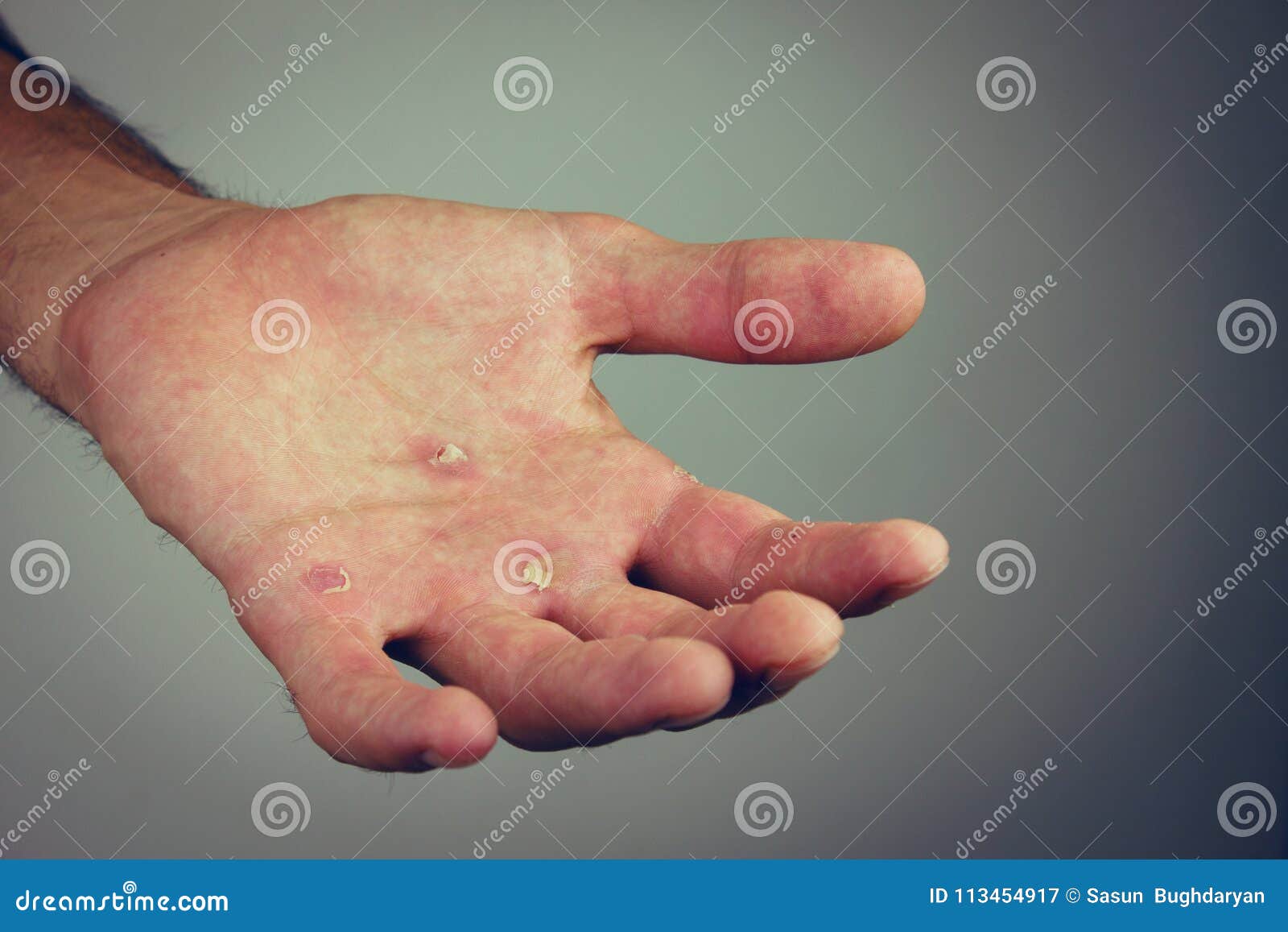 Handen Met Blaar En Eeltplek Stock Afbeelding - Image of sterk ...