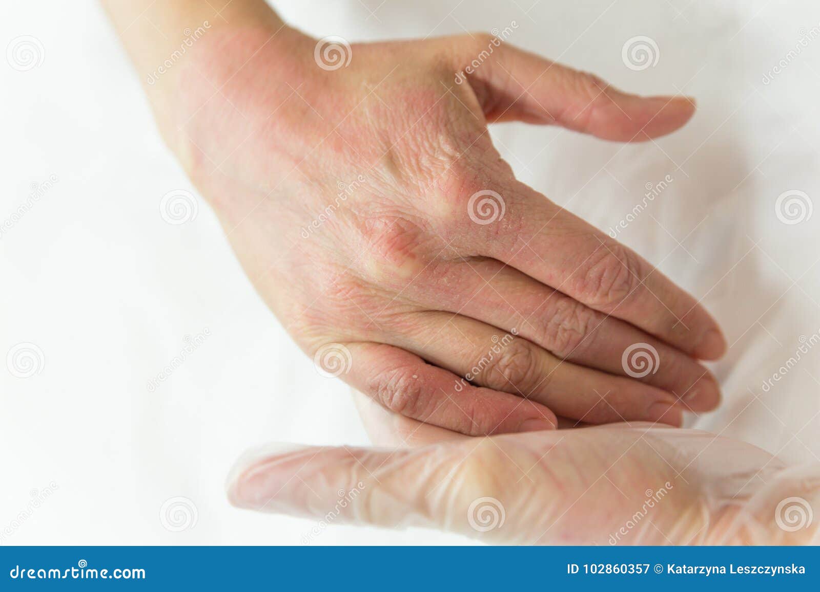 Handen Van Vrouw Met Huidproblemen Stock Afbeelding - Image of ziekte ...