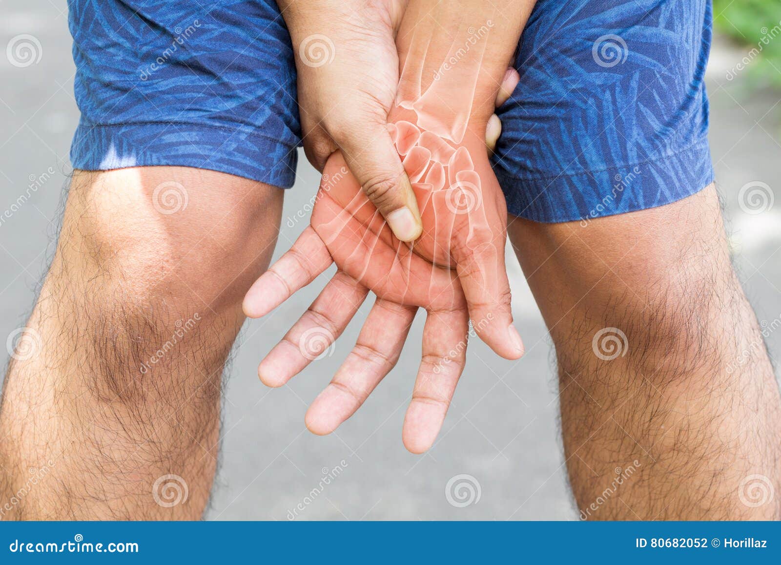 Handknochenverletzung stockfoto. Bild von medizin, rheumatisch - 80682052
