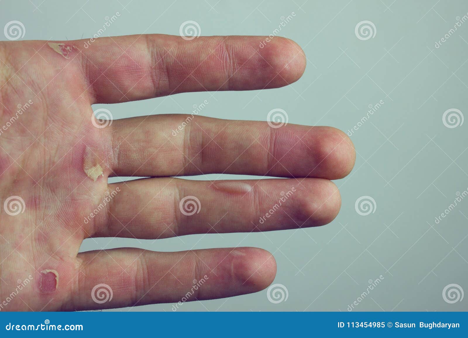 Hands with Blister and Callus Stock Image - Image of callus, close ...