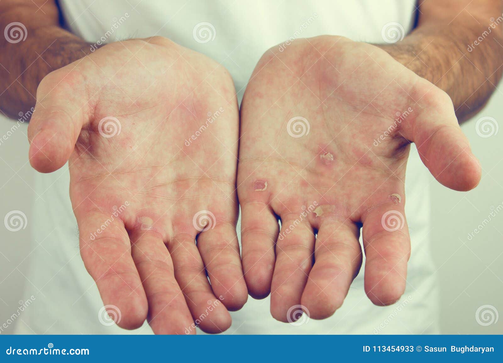 Hands with Blister and Callus Stock Image - Image of close, body: 113454933