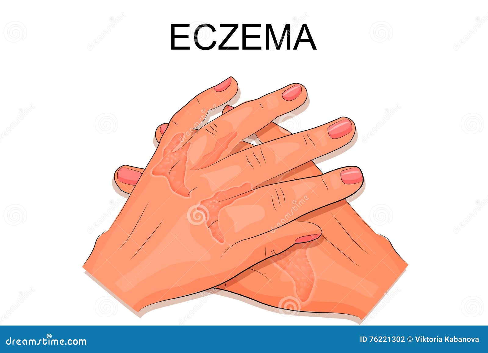 Hands of a Patient Suffering from Eczema Stock Vector - Illustration of ...