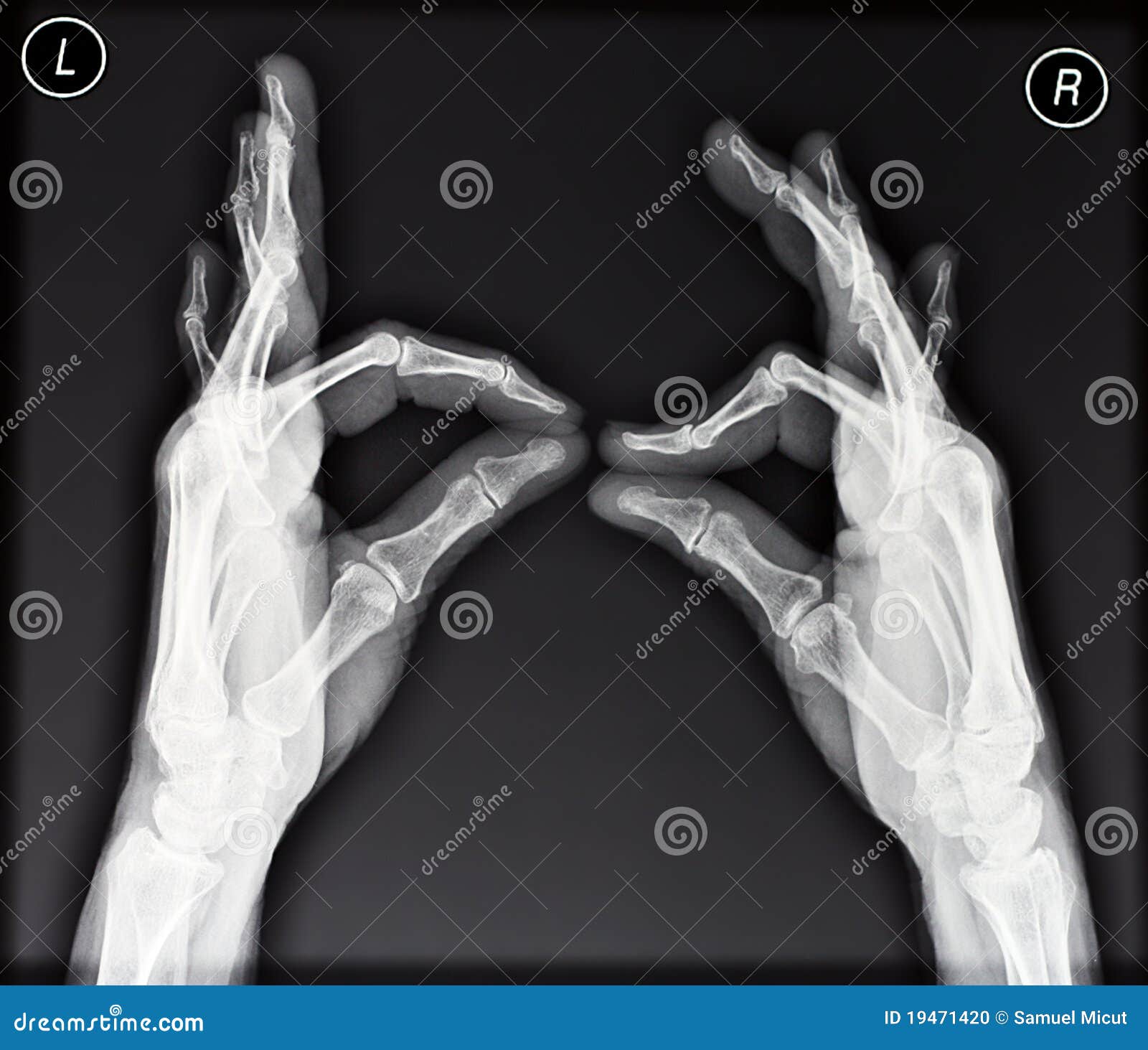 Hands X-ray stock photo. Image of human, joint, examination - 19471420