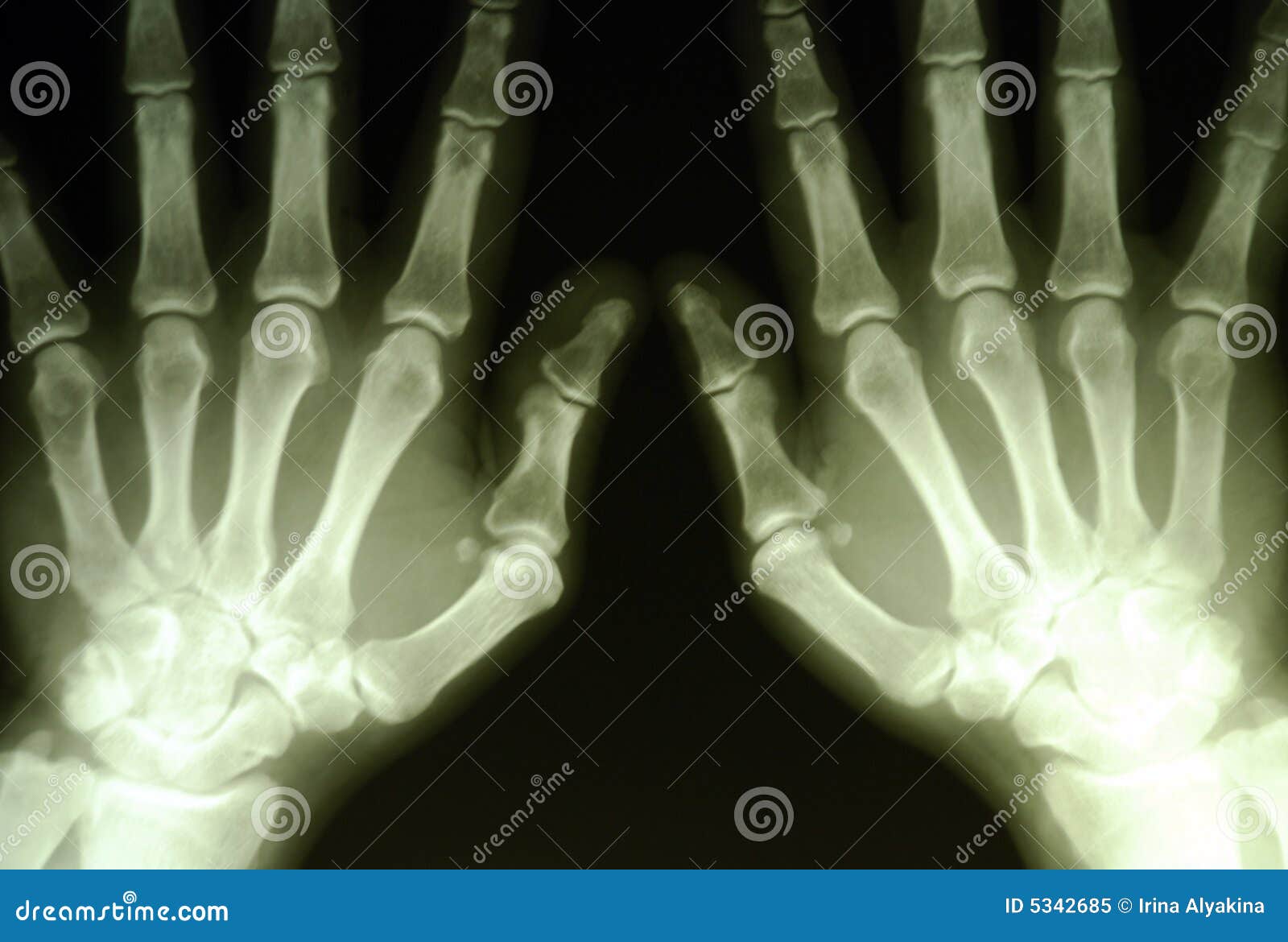 Hands roentgenogram stock image. Image of rontgen, roentgenogram - 5342685