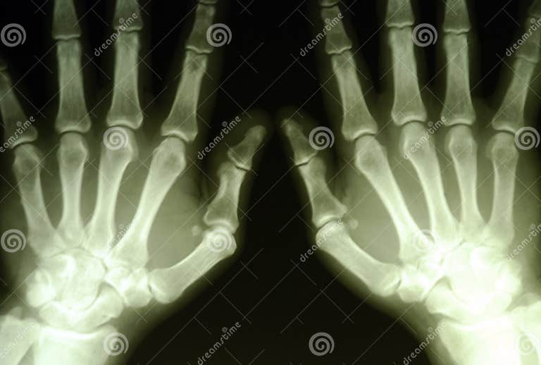 Hands roentgenogram stock image. Image of rontgen, roentgenogram - 5342685