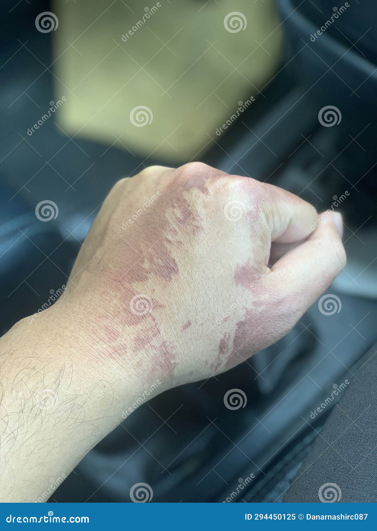 Burning hand stock image. Image of water, hands, scalded - 294450125