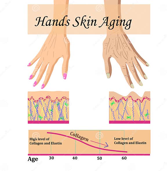 Hands Skin Aging, Vector Illustration with a Chart Stock Vector ...
