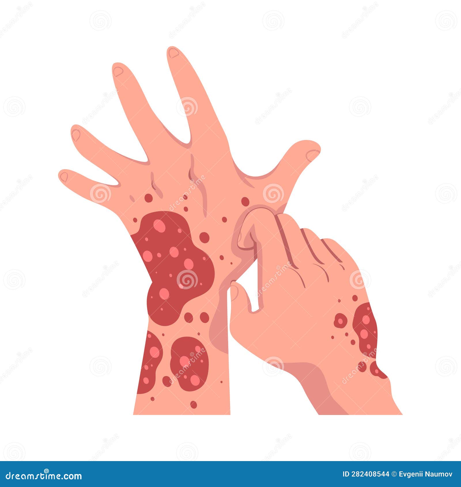 Sad Man Suffering From Psoriasis, Eczema Or Dermatitis Scratches Rashes ...