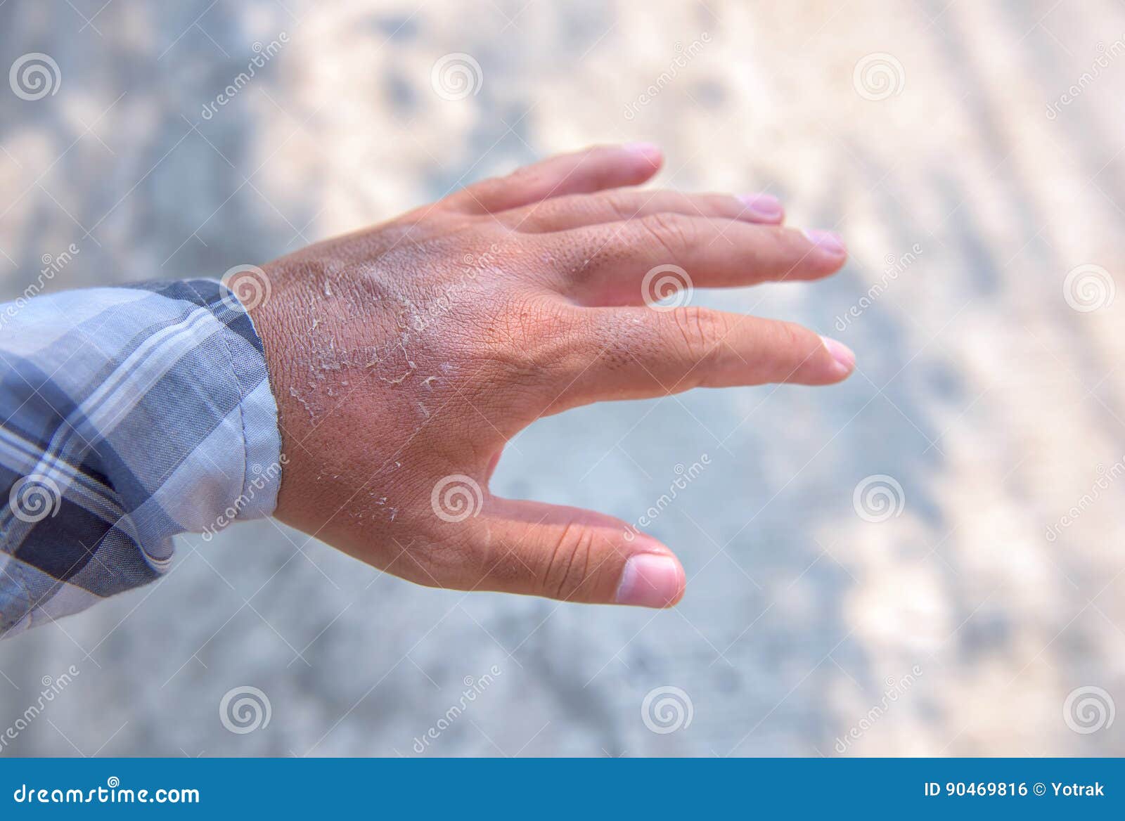 Hands after sunburn stock photo. Image of hands, health - 90469816
