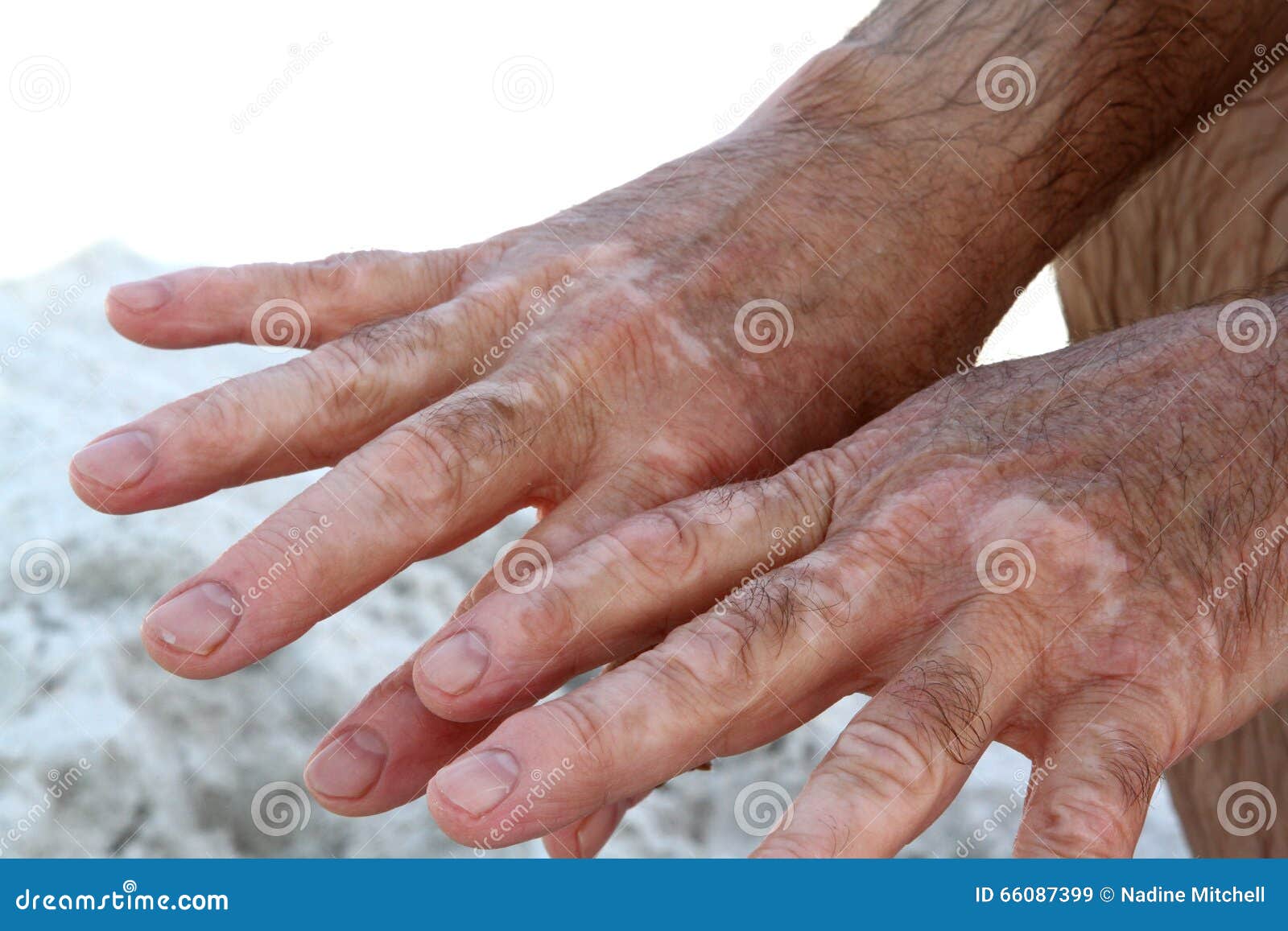Vitiligo On The Skin Of Hands. Finger Indicates Skin Defect Stock Photo ...