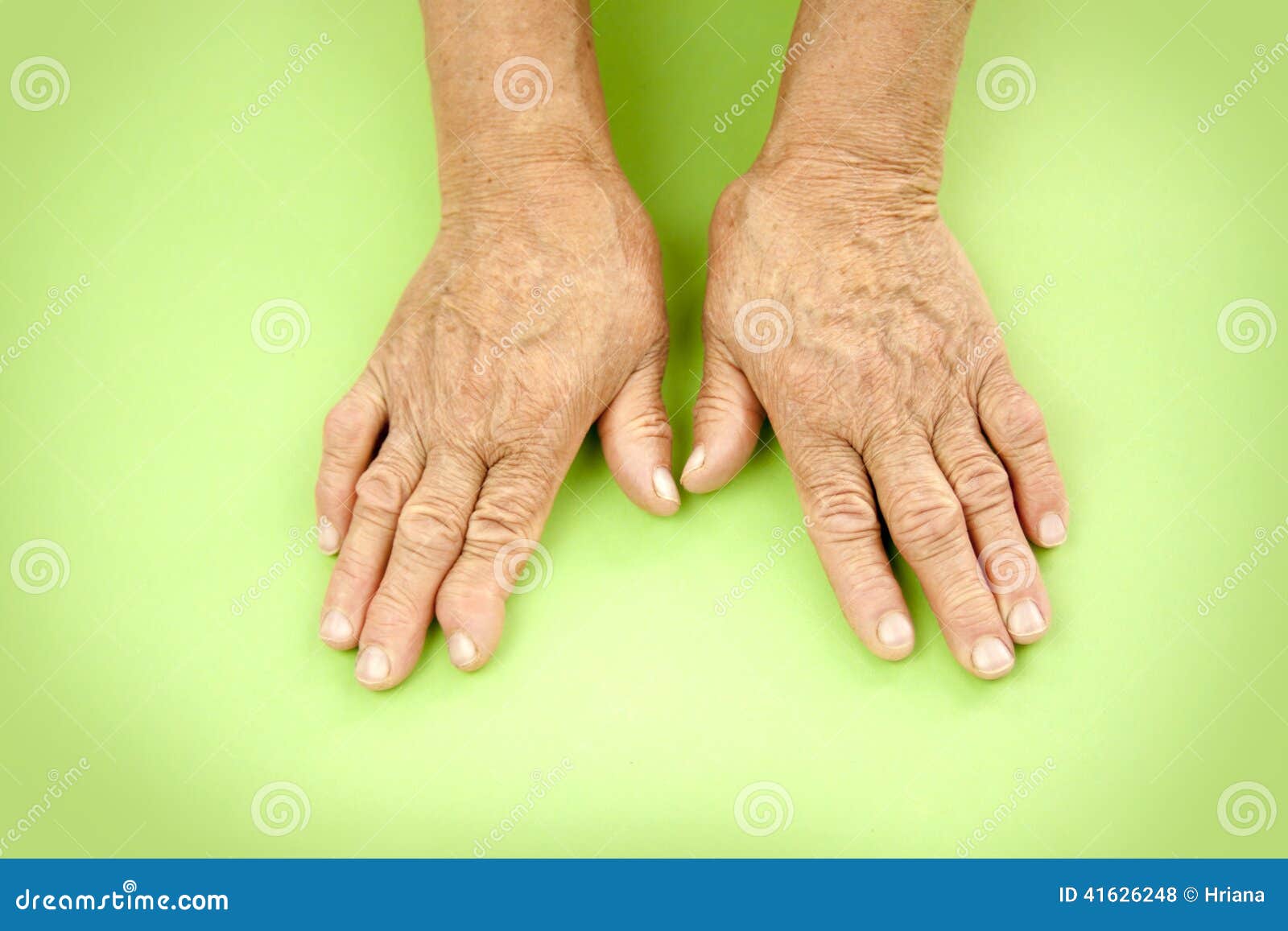 Hands of Woman Deformed from Rheumatoid Arthritis Stock Photo - Image ...