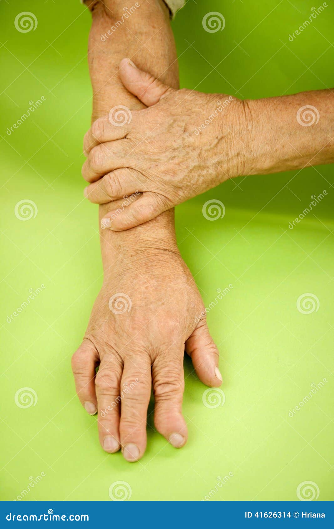 Hands of Woman Deformed from Rheumatoid Arthritis Stock Photo - Image ...