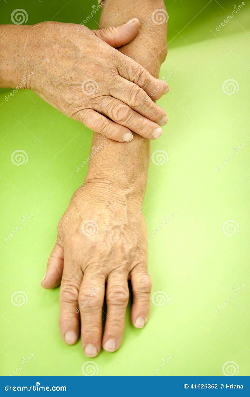 Hands of Woman Deformed from Rheumatoid Arthritis Stock Photo - Image ...