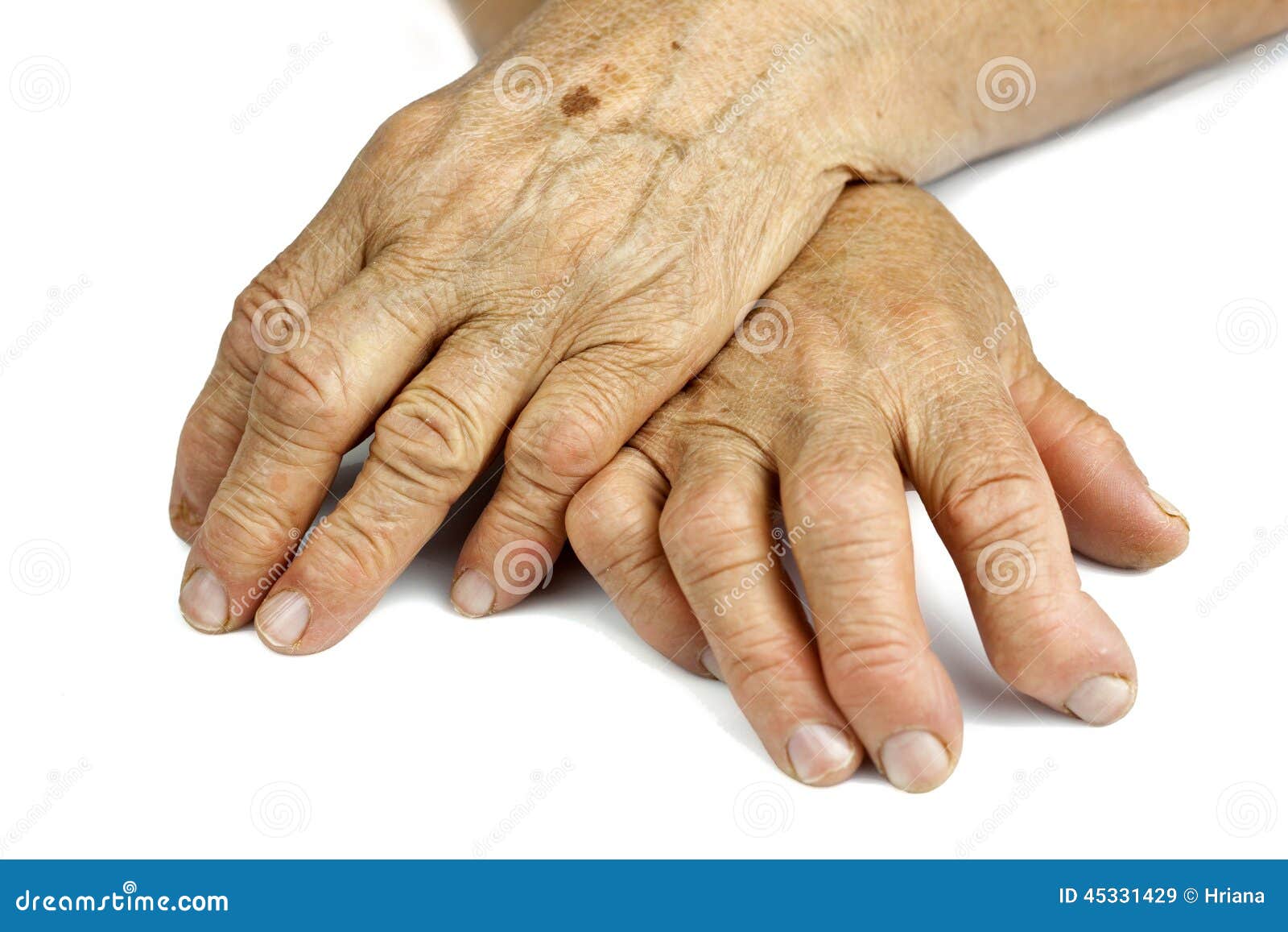Hands of Woman Deformed from Rheumatoid Arthritis Stock Image - Image ...
